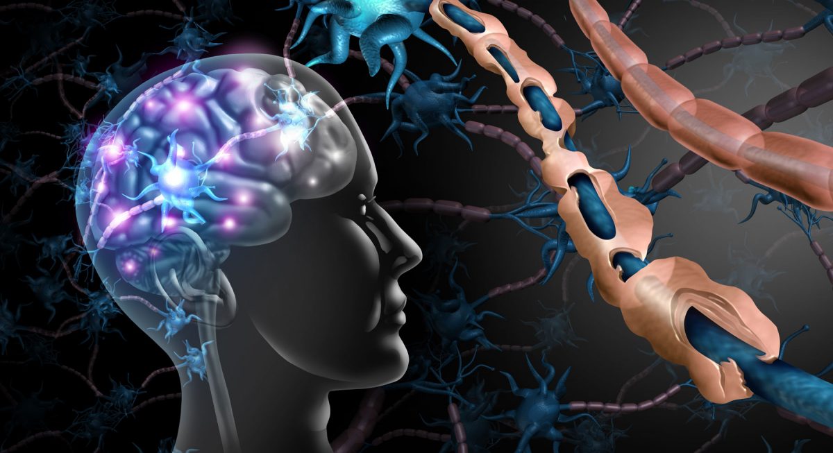 Multiple Sclerosis MS Disease Rougine Darou